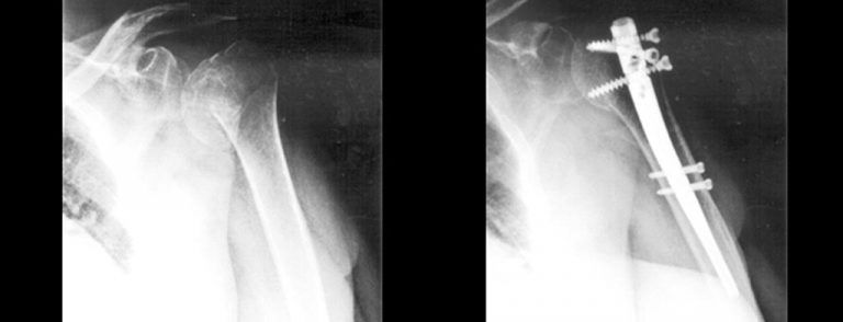 Polarus Humeral Rod System | Acumed