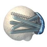 Polarus Proximal Humeral Plating System | Acumed