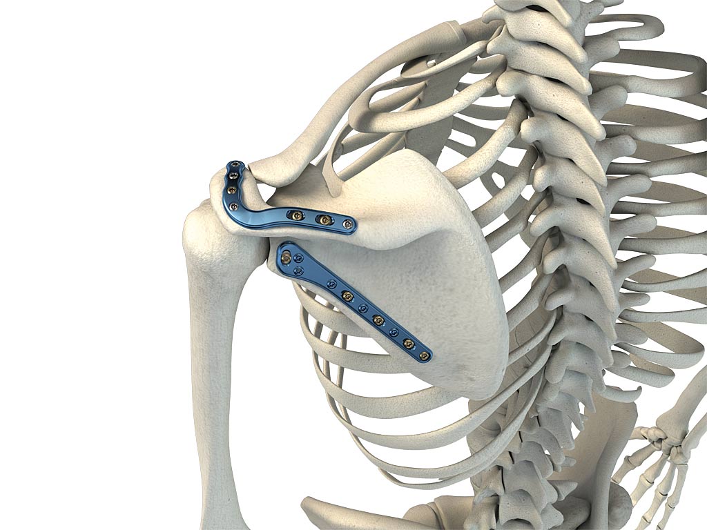 Scapula Plating System | Acumed