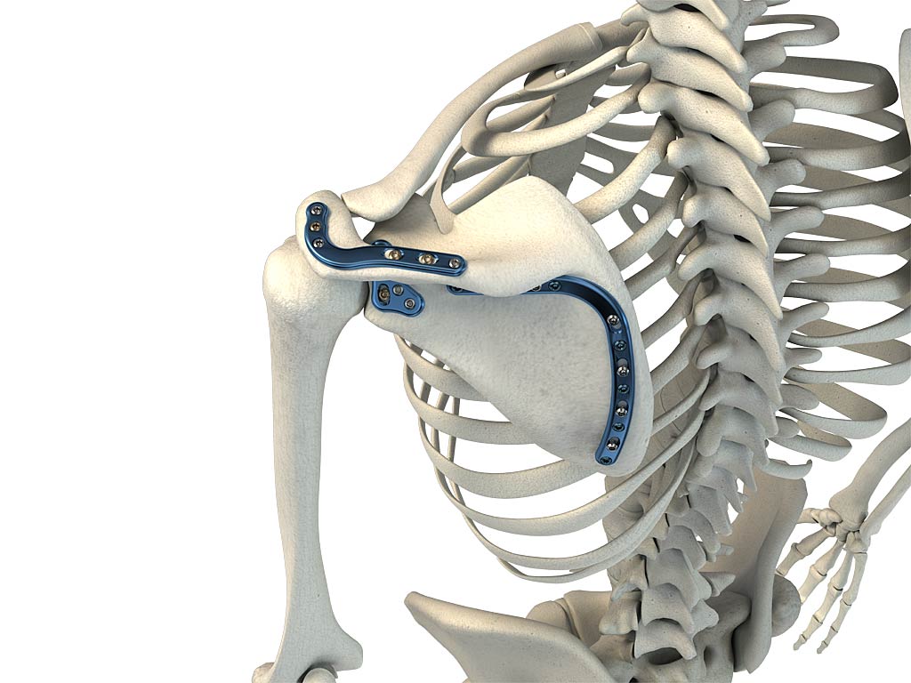 Scapula Plating System | Acumed