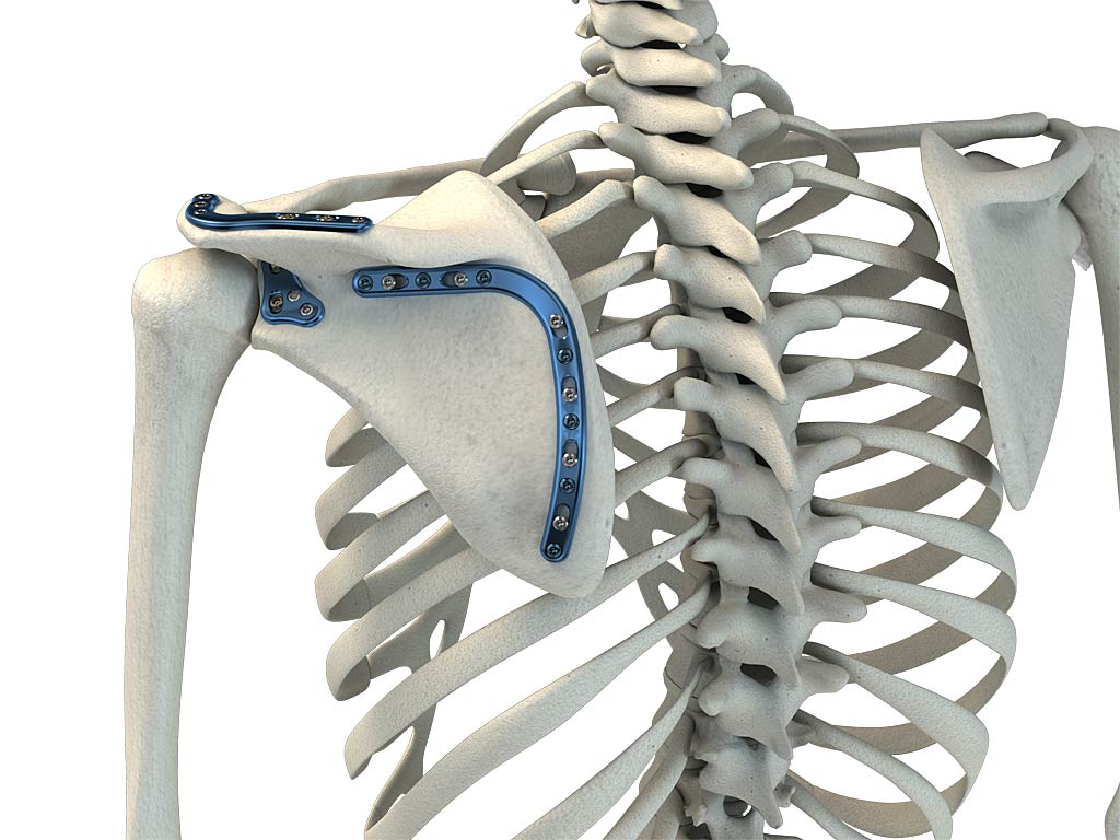 Scapula Plating System | Acumed