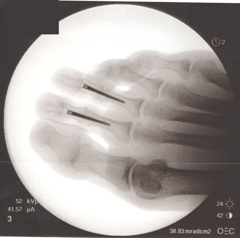 Acutrak Headless Compression Screw System | Acumed