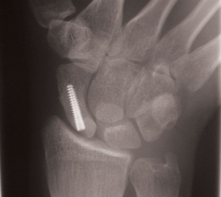 Acutrak Headless Compression Screw System | Acumed