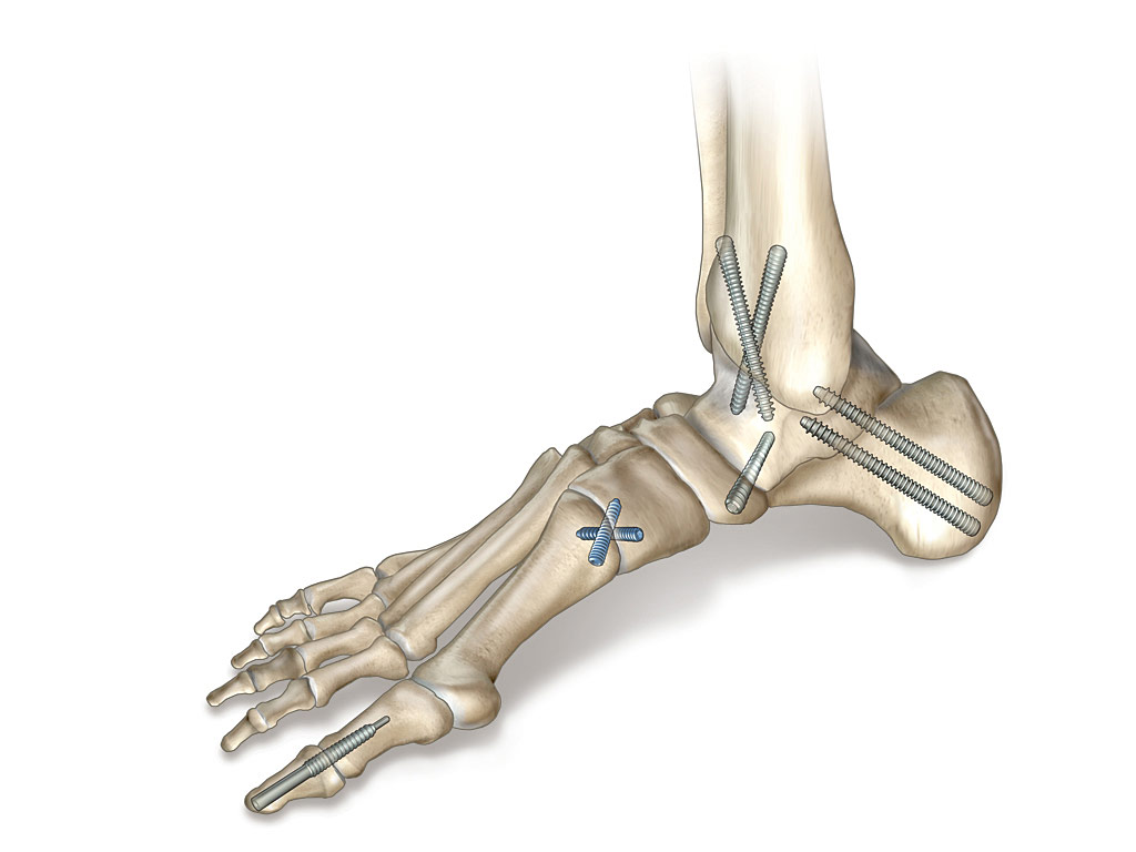 Acutrak Headless Compression Screw System | Acumed