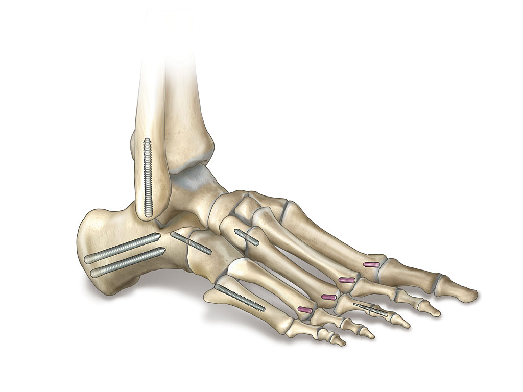 Acutrak Headless Compression Screw System | Acumed