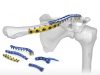 Clavicle Plating System | Acumed