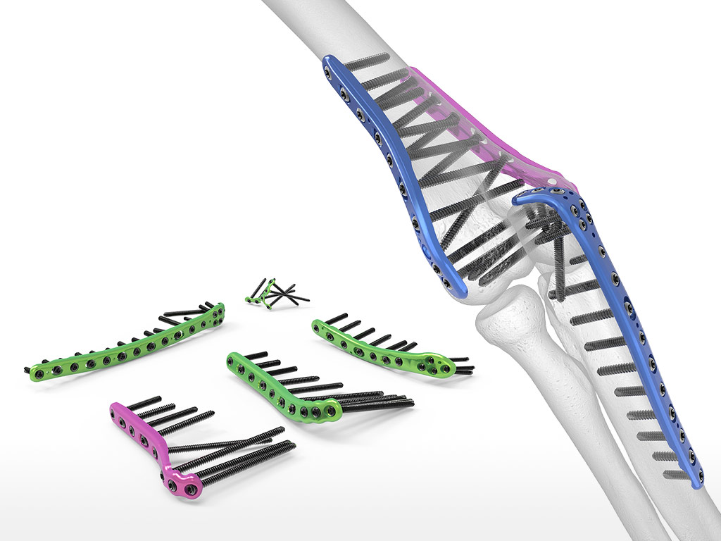 Elbow Plating System | Acumed