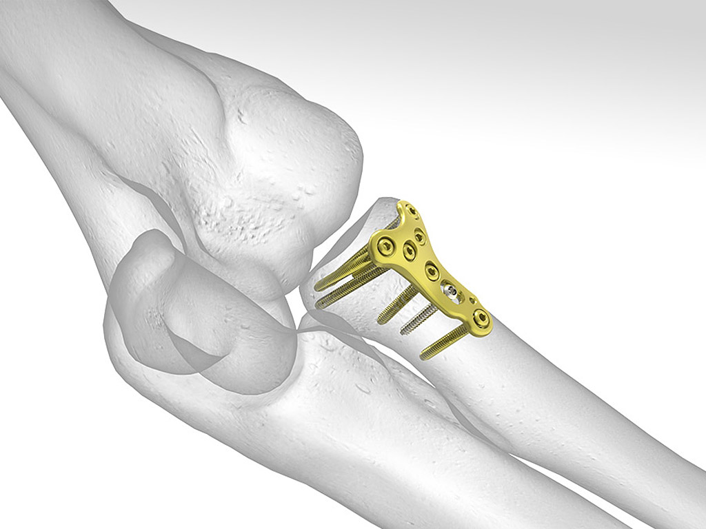 Radial Head Plating System | Acumed