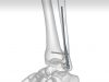Fibula Rod System | Acumed