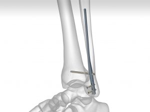 Fibula Rod System | Acumed