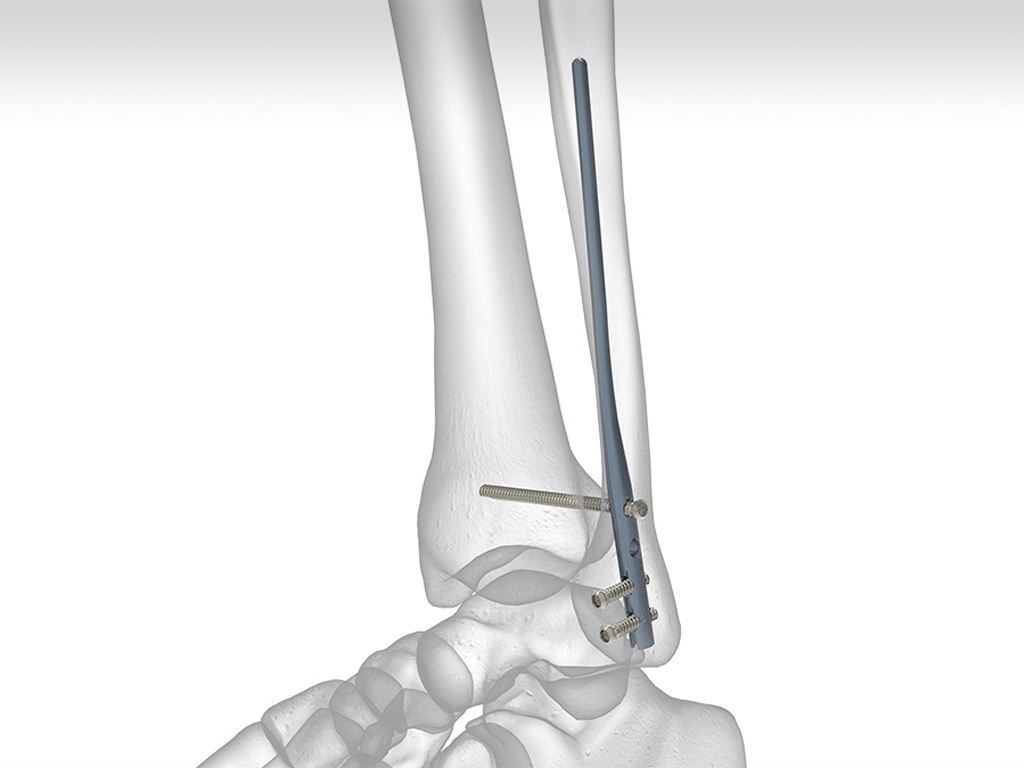 Fibula Rod System | Acumed
