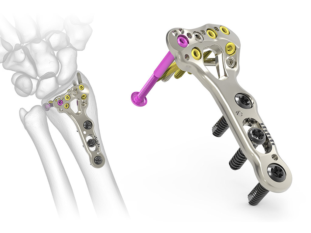 Acu-Loc 2 Wrist Plating System | Acumed