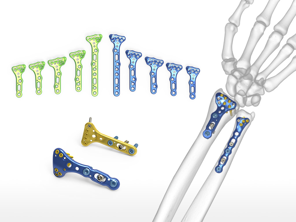 Acu-Loc Wrist Plating System | Acumed
