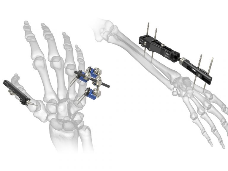 External Fixation System | Acumed