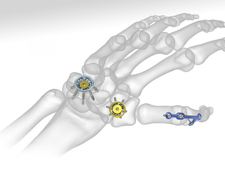 Modular Hand System | Acumed