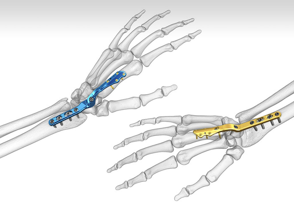 Total Wrist Fusion Plating System | Acumed
