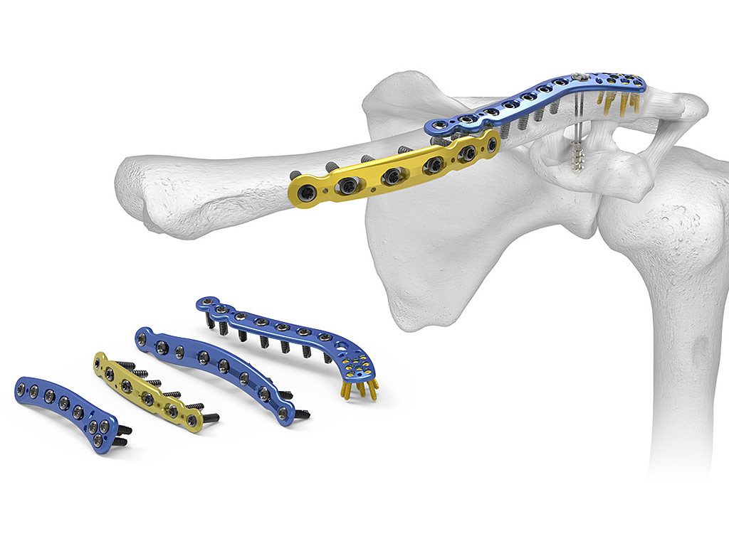 Clavicle Plating System | Acumed
