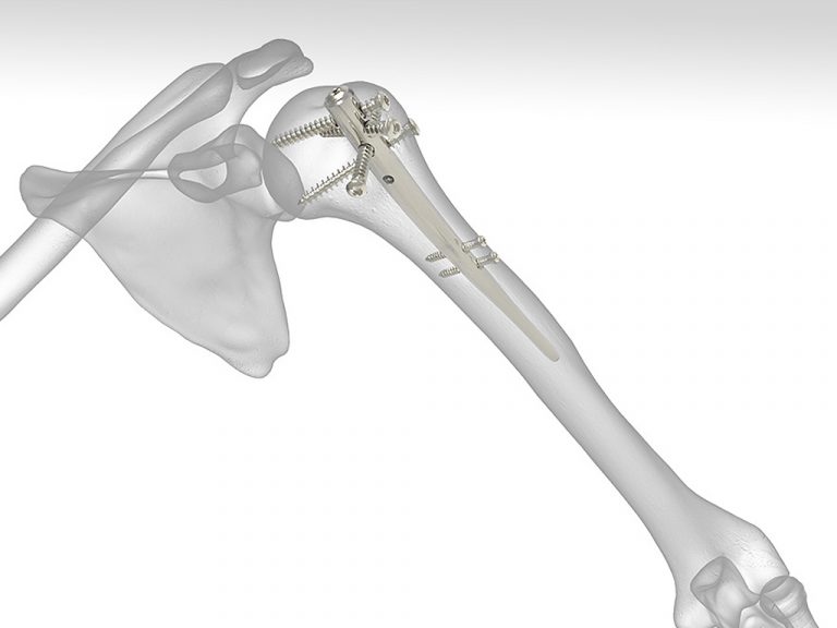Polarus Humeral Rod System | Acumed