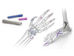 Acutrak 2 Headless Compression Screw System | Acumed