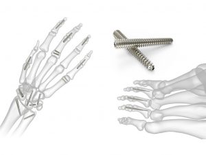 Acutrak Headless Compression Screw System | Acumed