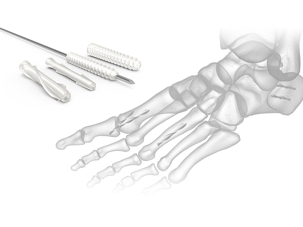 Biotrak Headless Resorbable Compression System | Acumed