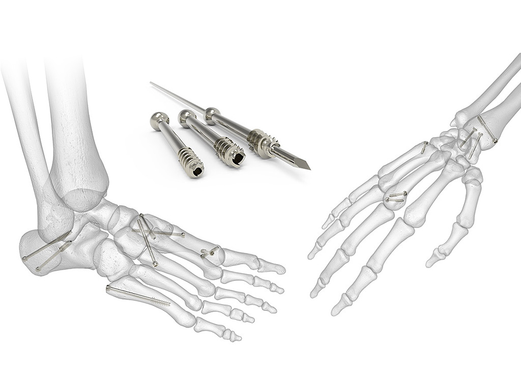 Extremity Screw System | Acumed