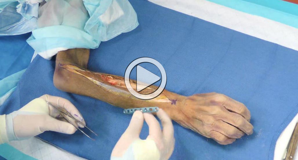 Radial Shaft Fracture Fixation Using Dorsolateral Midshaft Radius Plate ...