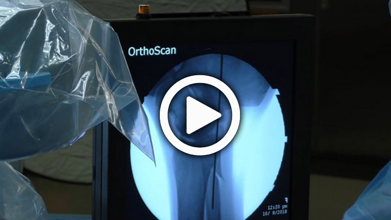 Weber B Fracture Fixation Using the Fibula Rod with Alastair Younger ...