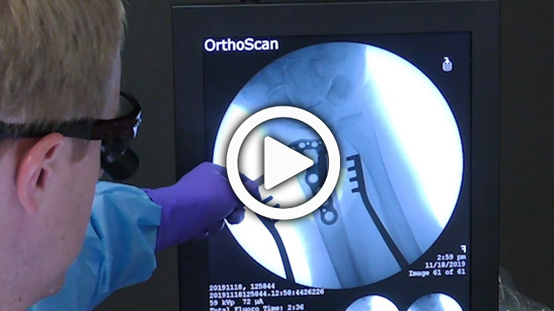 Fixation of a Distal Radius Fracture Using a Proximal VDR Plate with ...