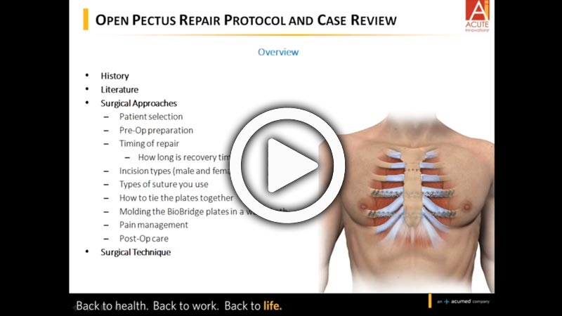 Open Pectus Repair Protocol and Case Review with Daniel Miller, MD | Acumed