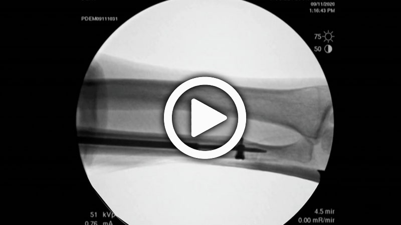 Ulna Nail 2 Surgical Lab with Roy W Sanders, MD | Acumed