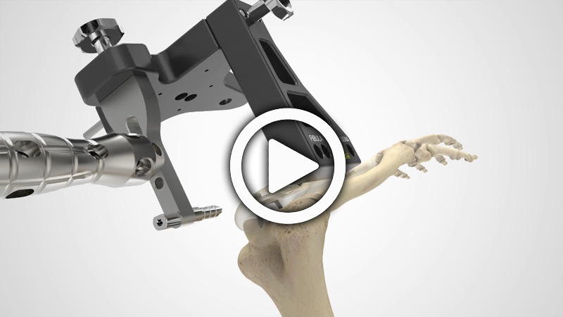 Ulna Nail 2 System Overview Animation Acumed