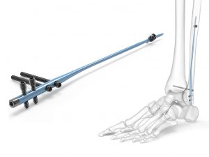 Fibula Nail 2 System | Acumed