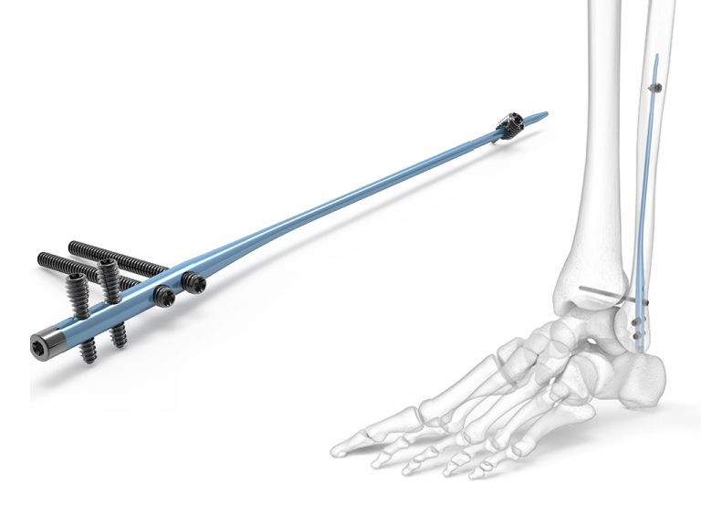 Fibula Nail 2 System | Acumed