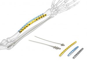 Forearm Fracture Solutions | Acumed