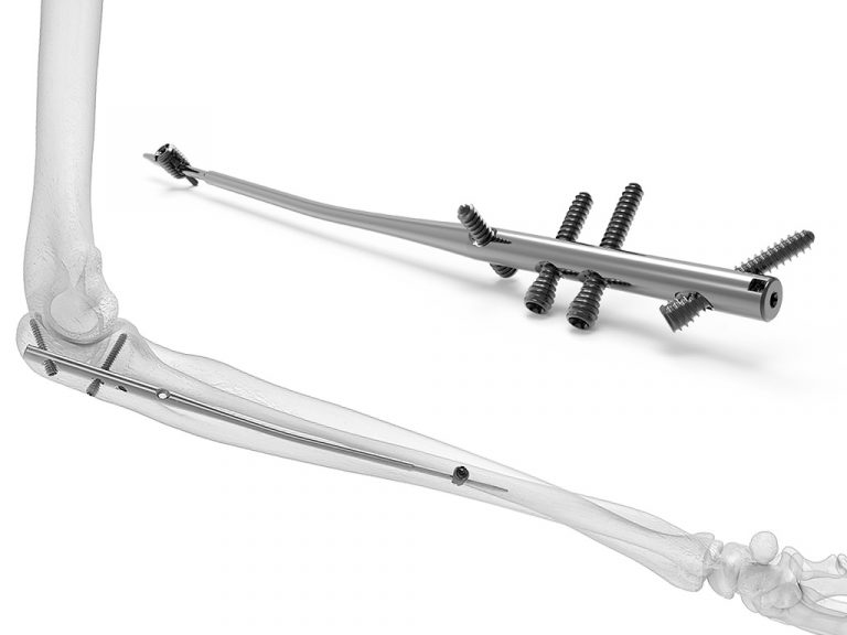 Ulna Nail 2 System | Acumed