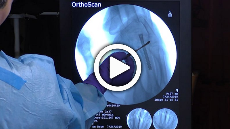 Retrograde Intramedullary Screw Fixation of a Metacarpal Shaft Fracture ...