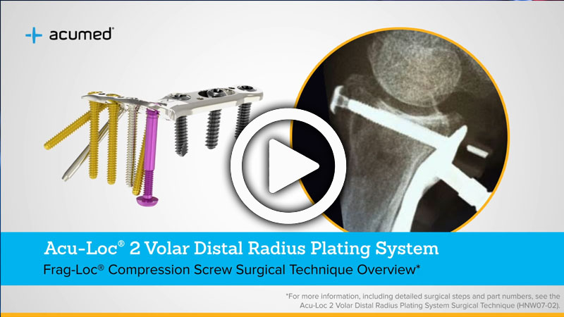 Acu-Loc 2 Frag-Loc Compression Screw Surgical Technique Overview ...