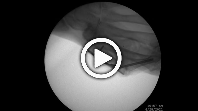 OsteoMed Hand Fusion System Surgical Technique Lab with Dr. William ...