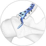 Acumed | Innovation With Purpose