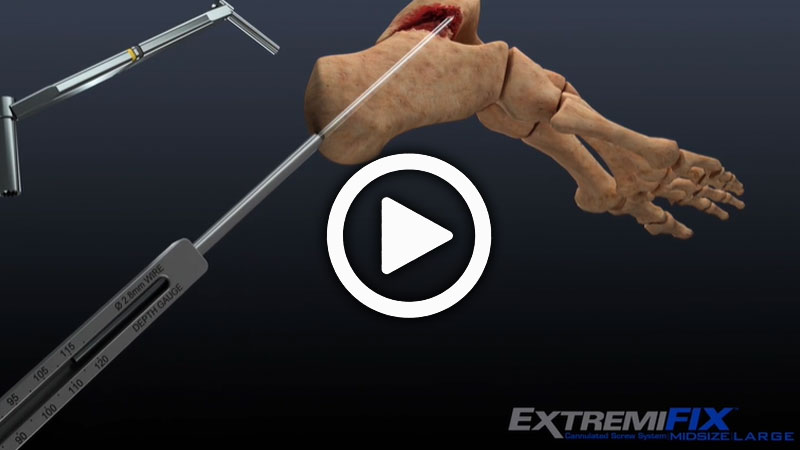 ExtremiFix Cannulated Screw System – Midsize & Large System Overview ...