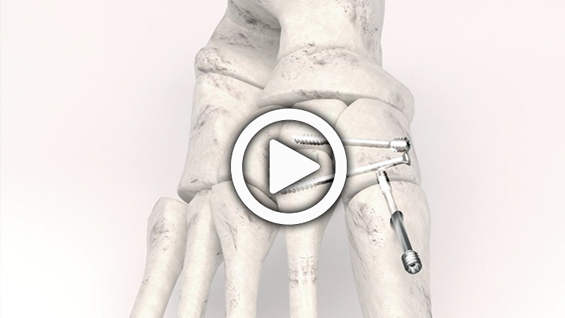 ExtremiFix Cannulated Screw System – Mini & Small Overview | Acumed