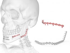 MFx Mandibular Fixation System | Acumed