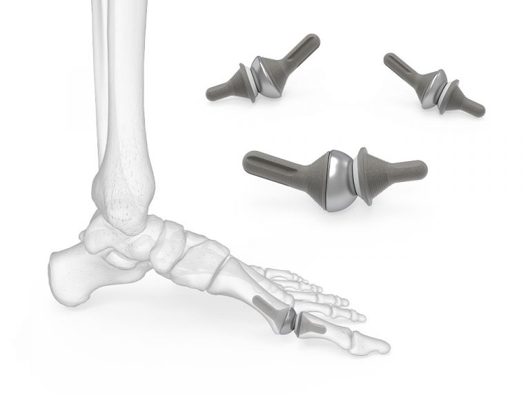 ReFlexion 1st MTP Implant System | Acumed