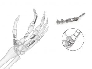 Hand Fusion System (HPS) | Acumed