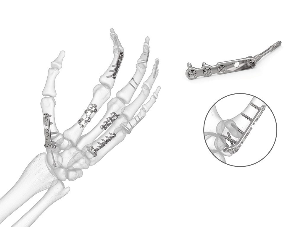 Hand Fusion System (HPS) | Acumed
