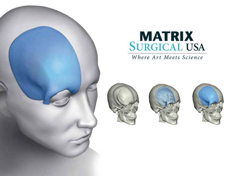Matrix Omnipore Customized Surgical Implants | Acumed