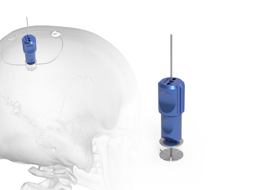 OsteoFlap Cranial Clamp System | Acumed