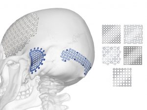 OsteoForm Cranial Mesh | Acumed