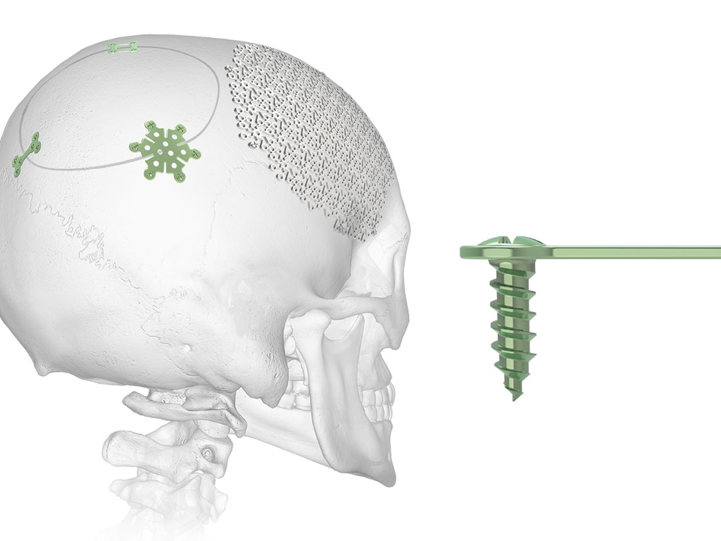 Profile Plus Standard Profile Plating System | Acumed